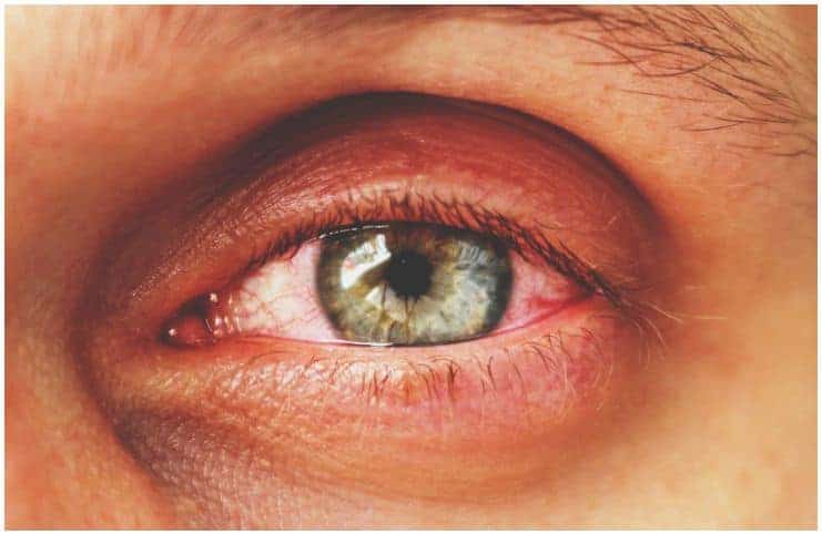 Conjunctivitis (Pinkeye) Spiritual Meaning & Causes - Insight state