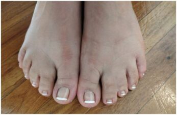 Syndactyly (Webbed Toes) - Spiritual Meaning & Causes - Insight state