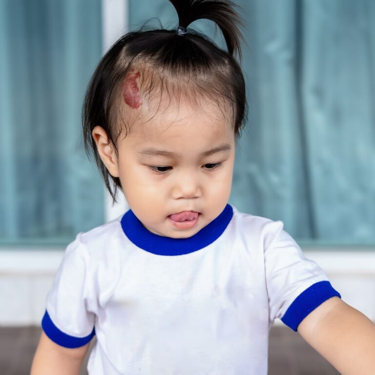 Birthmarks - Spiritual Meanings & Superstitions - Insight state